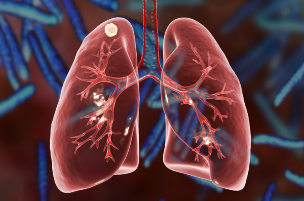 Foreign Body in Bronchus - ASIAN ENT CARE