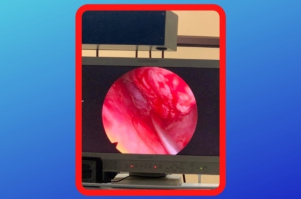 Inferior Turbinoplasty - ASIAN ENT CARE