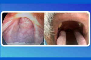 Uvulopalatopharyngoplasty - ASIAN ENT CARE